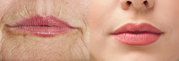Facial Aging Surprise, AZ | Rejuvenate Face |Brow, Neck Rejuvenation